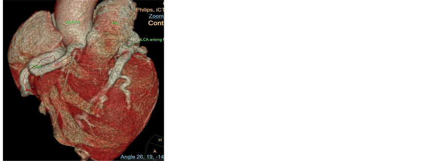 Adult ALCAPA Syndrome-Anomalous Origin of Left Coronary Artery from ...