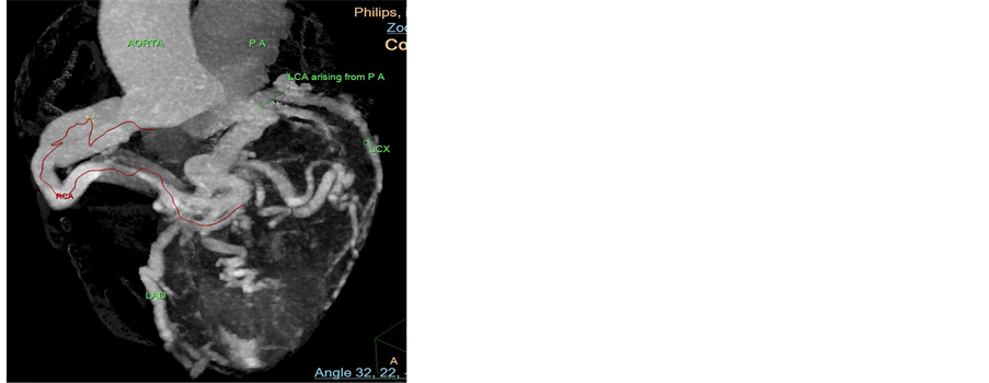 Adult ALCAPA Syndrome-Anomalous Origin of Left Coronary Artery from ...