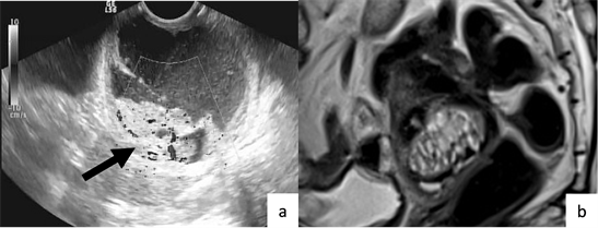 Clear Cell Carcinoma Of The Uterine Cervix Arising From An Interstitial Cyst Complicated With