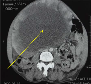 Cystic Degeneration of Uterine Leiomyoma Misdiagnosed as Ovarian ...