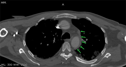 A Case Report about Persistent Left Superior Vena Cava: Is it Always ...
