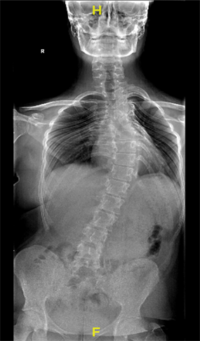 Successful Congenital Kyphoscoliosis (with Severe Truncal Shift ...