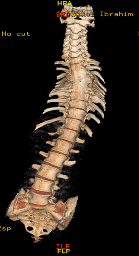 Successful Congenital Kyphoscoliosis (with Severe Truncal Shift ...