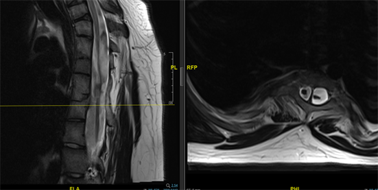 Successful Congenital Kyphoscoliosis (with Severe Truncal Shift ...