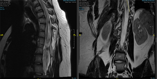 Successful Congenital Kyphoscoliosis (with Severe Truncal Shift ...