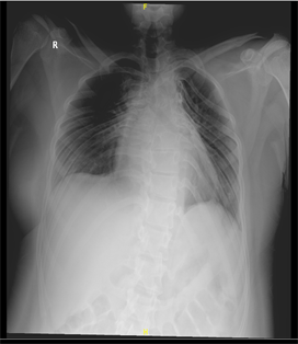 Successful Congenital Kyphoscoliosis (with Severe Truncal Shift ...
