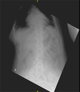 Successful Congenital Kyphoscoliosis (with Severe Truncal Shift ...