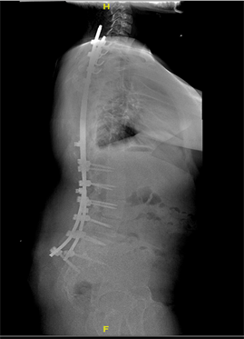 Successful Congenital Kyphoscoliosis (with Severe Truncal Shift ...