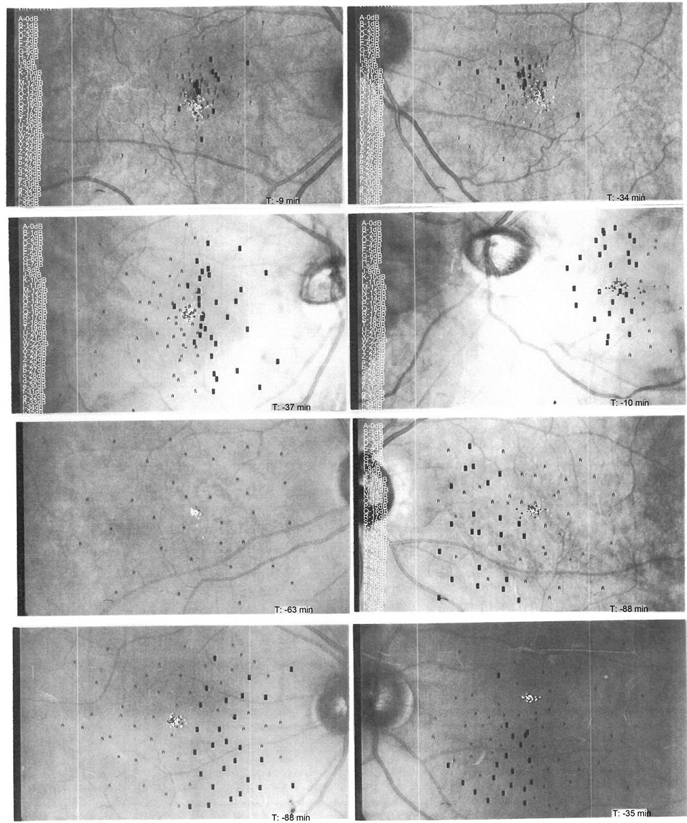 Central Retinal Microperimetry by Scanning Laser Ophthalmoscopy in ...