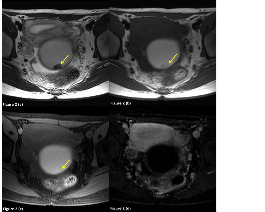 MR Differentiation of Endometriomas Complicated with and without ...