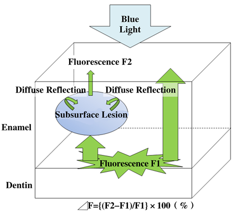 Advantage of Introducing Quantitative Light-Induced Fluorescence in ...