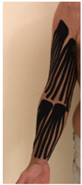 Evaluation of Taping in the Lymphatic System through Lymphoscintigraphy ...