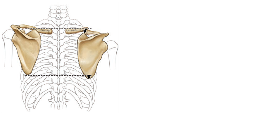 Influence of Displaced Clavicle Fracture toward Scapular Motion