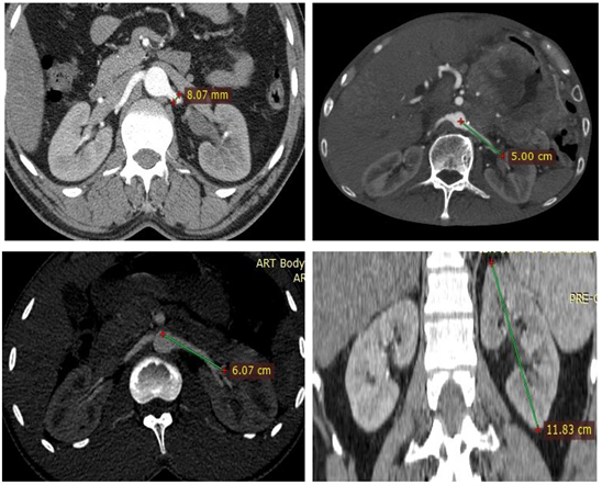 Evaluation of Renal Artery Anatomical Variations Using Multi-Detector ...