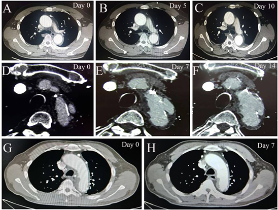 The Evaluation Characteristics of Type B Aortic Intramural Hematoma and ...