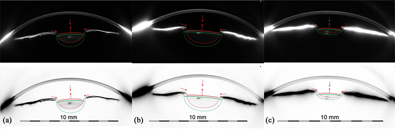 Scheimpflug Imaging of the Anterior Eye Segment during Standardized Accommodation Stimulation in ...