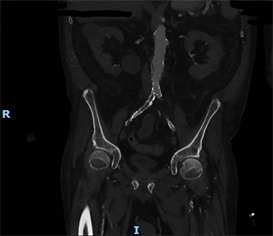 Calcific Uremic Arteriolopathy or Calciphylaxis in a Hemodialysis ...