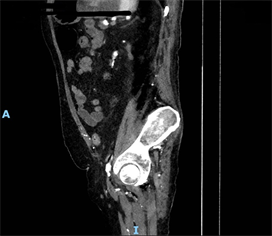 Calcific Uremic Arteriolopathy or Calciphylaxis in a Hemodialysis ...