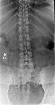 Lumbar Facet Cyst Causing S1 Radiculopathy with Concomittent Acute on ...