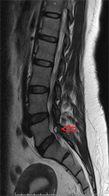 Lumbar Facet Cyst Causing S1 Radiculopathy with Concomittent Acute on ...
