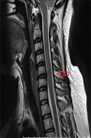 Lumbar Facet Cyst Causing S1 Radiculopathy with Concomittent Acute on ...
