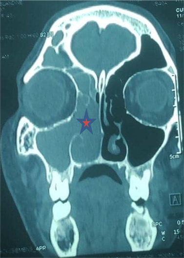 Correlation between Computed Tomography and Histopathology Findings of Sinonasal Tumors