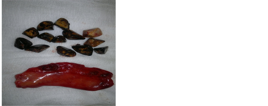 Acute Cholecystitis Mimics Ischemic Cardiac Disease: A Case Report and ...
