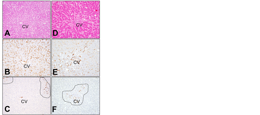 Hepatic Sinusoidal Obstruction Syndrome without Preceding Medical Events