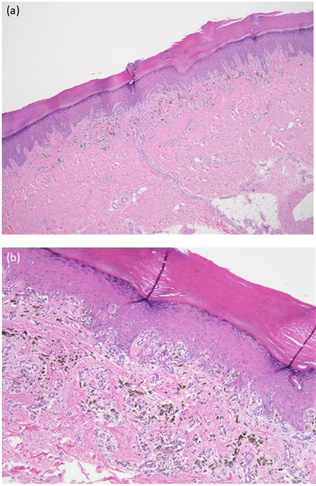 Plantar Spitz Nevus Resembling Malignant Melanoma: Description of ...