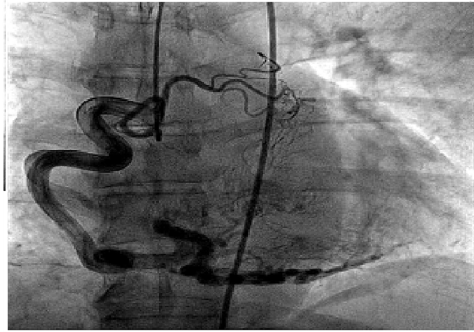 Anomalous Origin of Left Coronary Artery from Main Pulmonary Artery ...