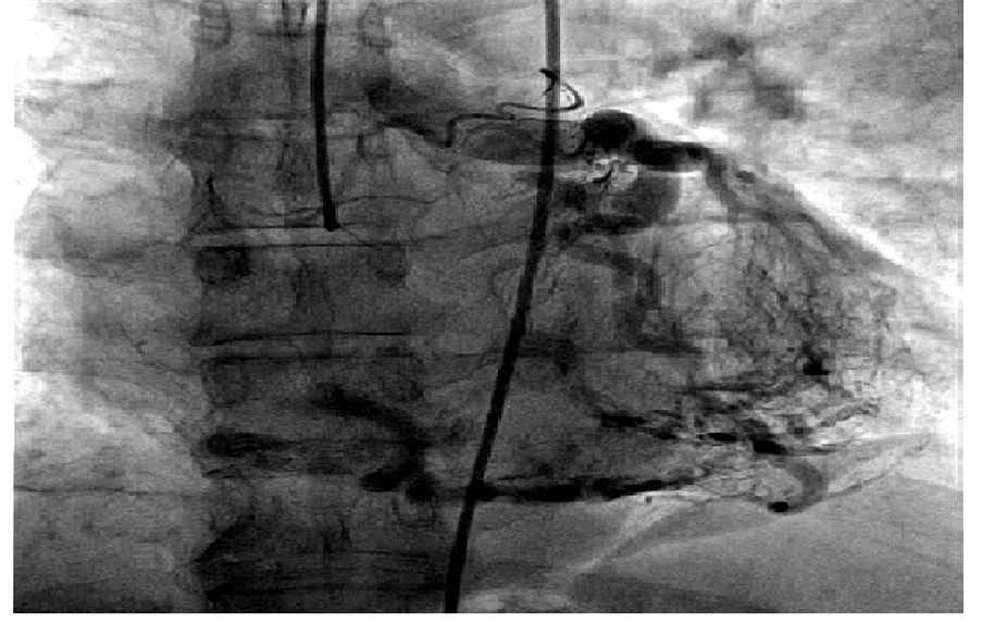 Anomalous Origin of Left Coronary Artery from Main Pulmonary Artery ...
