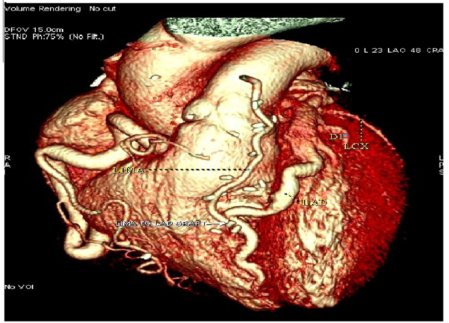 Anomalous Origin of Left Coronary Artery from Main Pulmonary Artery ...
