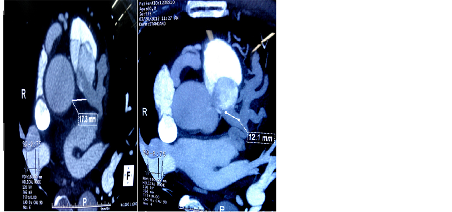 Anomalous Origin of Left Coronary Artery from Main Pulmonary Artery ...