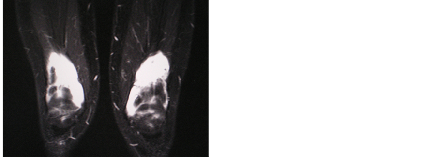 Monoarthropathy or Polyarthritis in Adolescent Japanese Girls Who ...