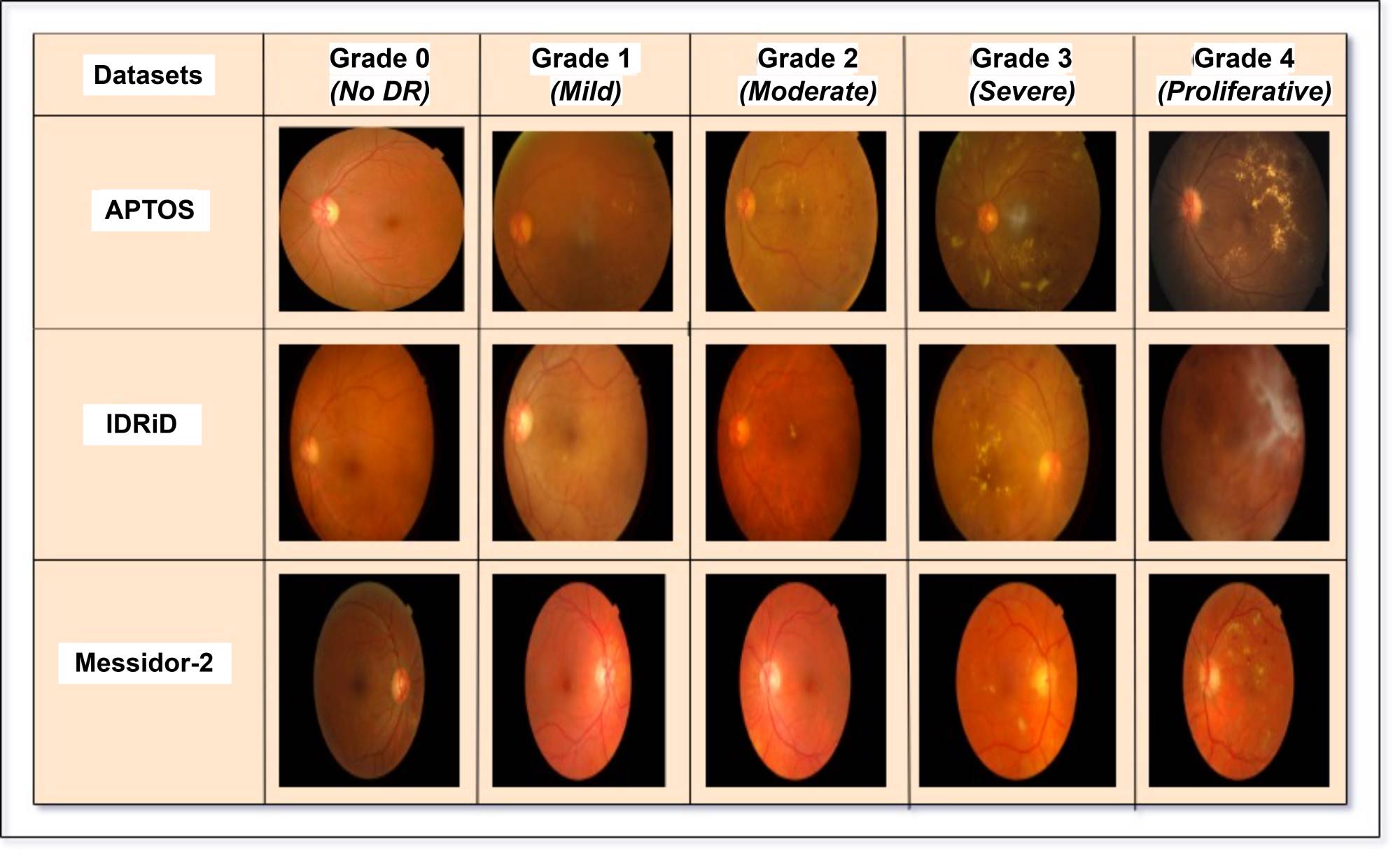 Diabetic Retinopathy Severity Classification Using Data Fusion and Ensemble Transfer Learning