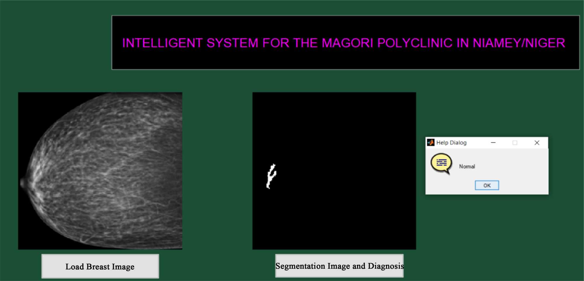 A Hybrid Learning Algorithm for Breast Cancer Diagnosis